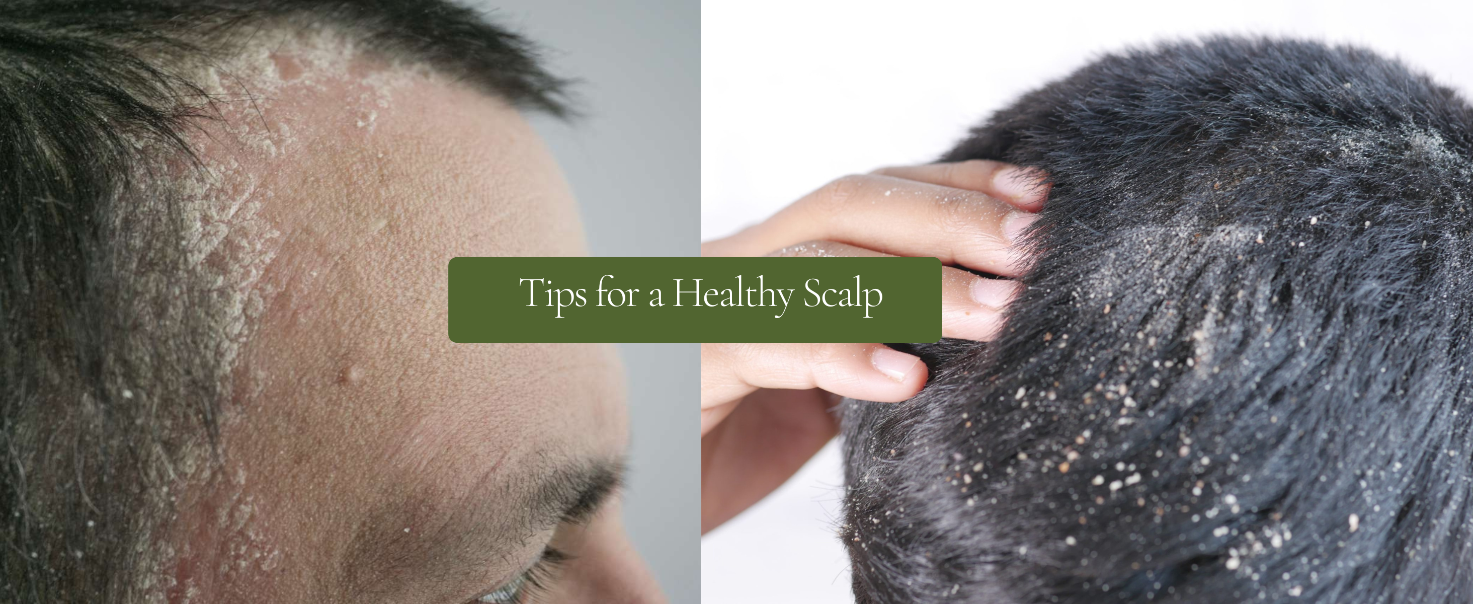 5 Best Dandruff Shampoos for Men That You Should Try – Abera.us