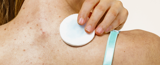 How to Get Rid of Body Acne: A Complete Guide – Abera.us