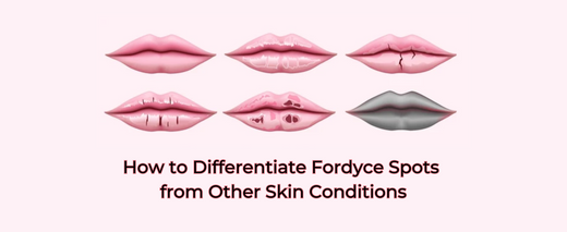 How to Differentiate Fordyce Spots from Other Skin Conditions – Abera.us