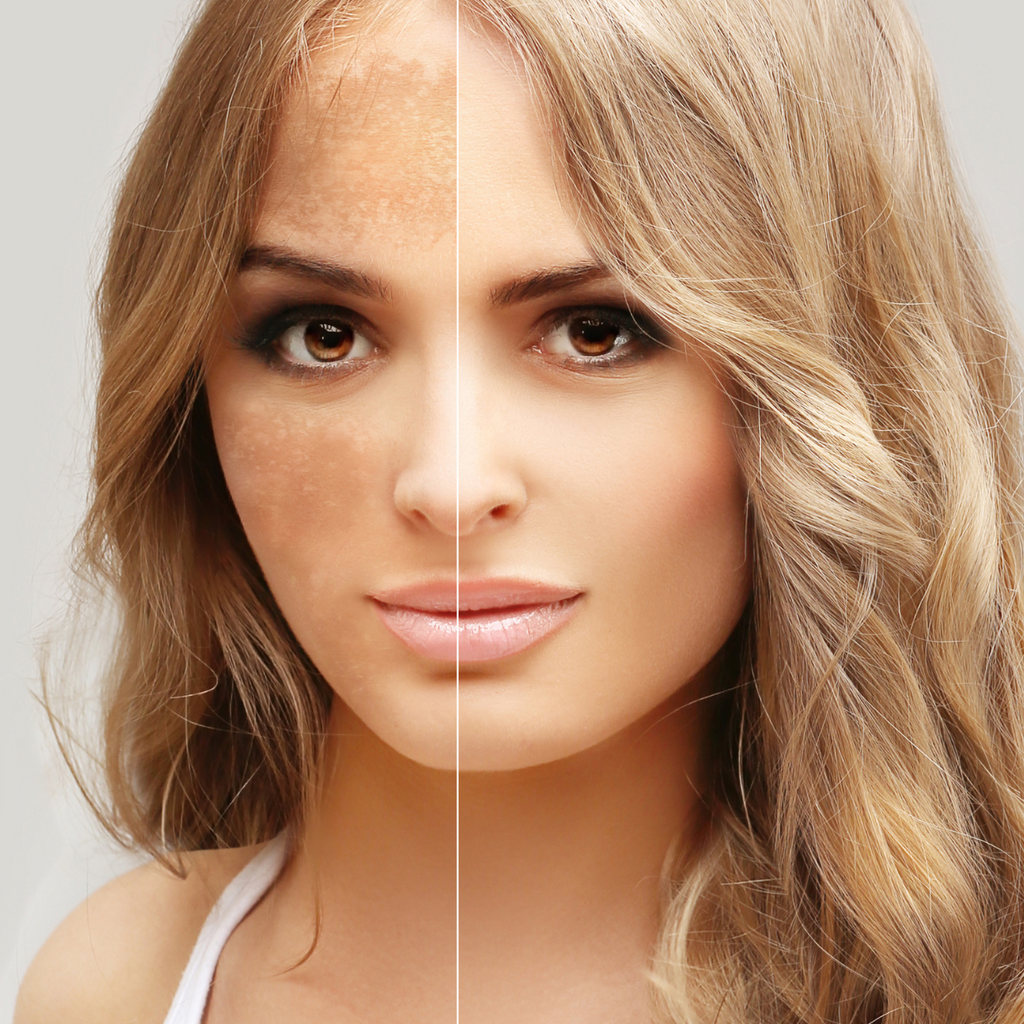 Best Ingredients for Treating Hyperpigmentation – Abera.us