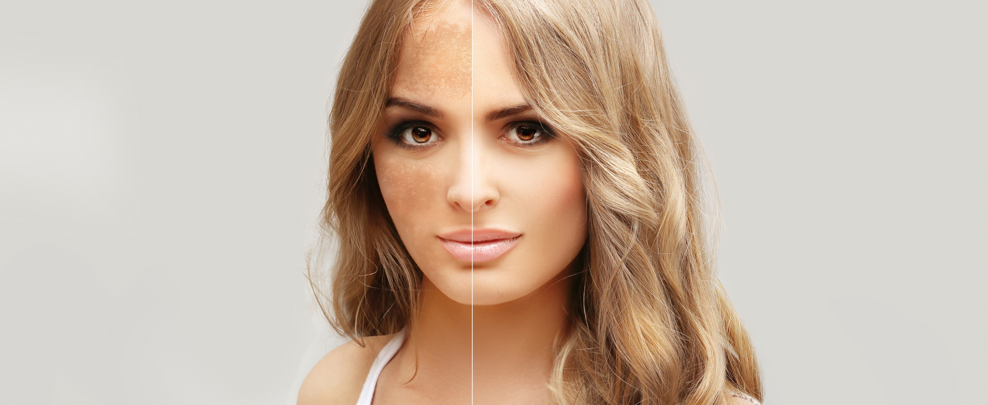 Best Ingredients for Treating Hyperpigmentation – Abera.us