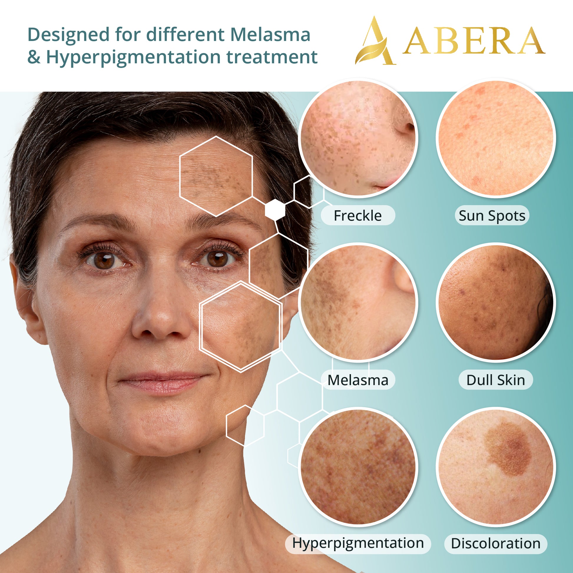 FALL MEGA SALE - ABERA Melasma Serum Treatment 20 ml (0.68 fl. Oz ...